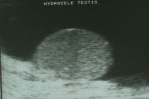 Hydrozele / Spermatozele - Andrologie Centrum München Prof. Dr. med. J ...